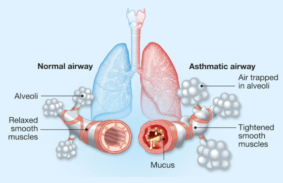 Should I See An Allergist Or A Pulmonologist For My Asthma Advanced Allergy ENT Denver